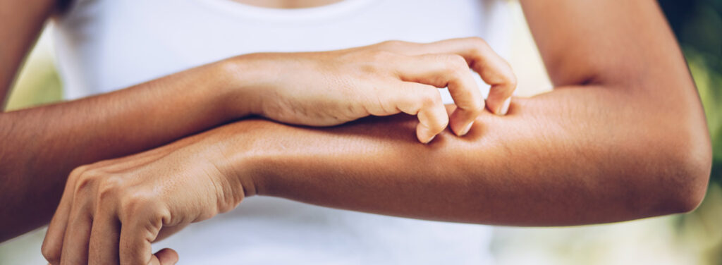 Contact Dermatitis - Harlan Steinhoff