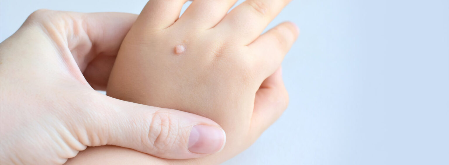 Warts - Harlan Steinhoff